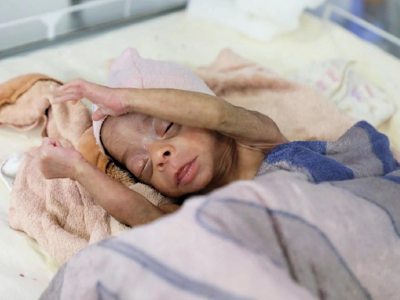 Every Second Counts, Preterm Baby Girl Needs Urgent Support to Survive ...