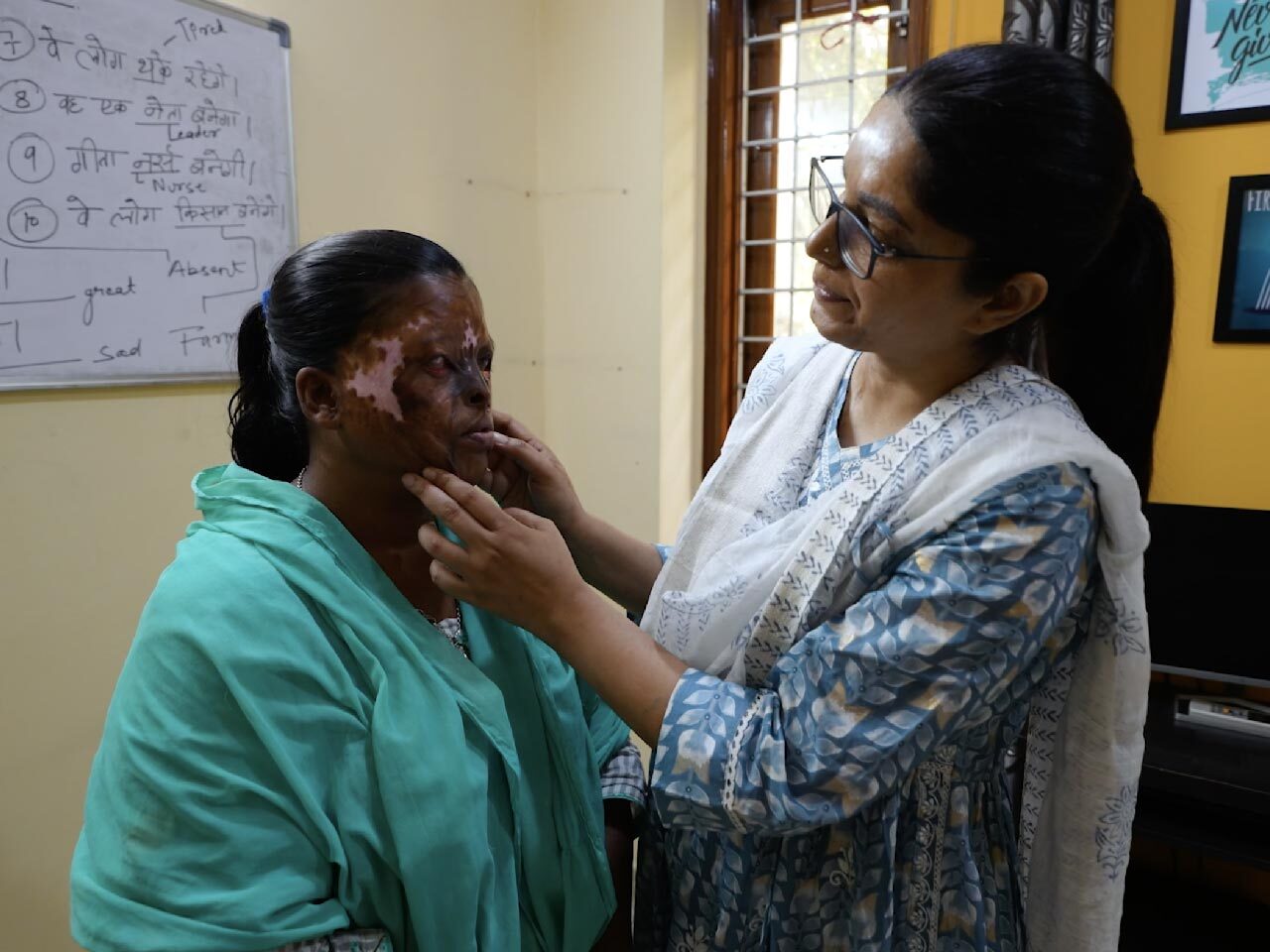 The Scars On Their Faces Couldn't Crush Their Spirit, These Acid Attack ...