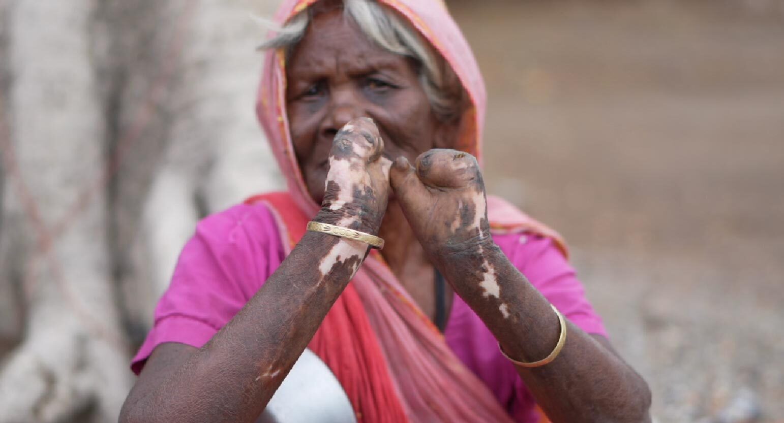 After Fighting Leprosy, Subhman Is Working Tirelessly To Help Other ...